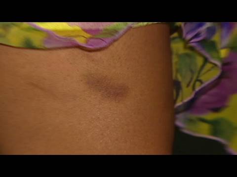 CNN: Finding the cause of bruising skin