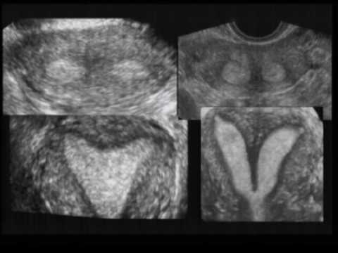 Uterine Anomalies Congenital and Acquired