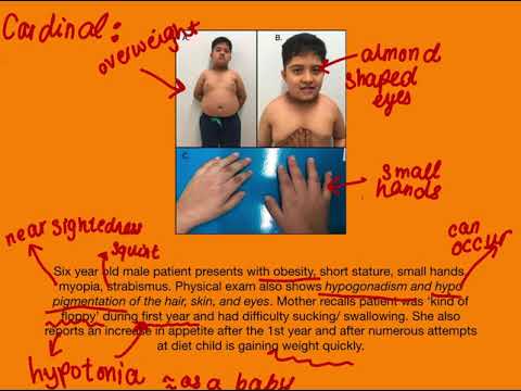 Prader-Willi Syndrome Clinical Case Medicine Genetics Paediatrics