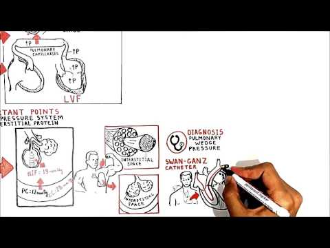 PULMONARY WEDGE PRESSURE (USMLE step 1 )