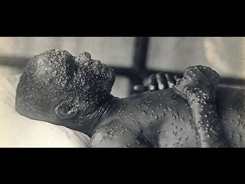 5 Rare Tragic Debilitating Diseases (AA)