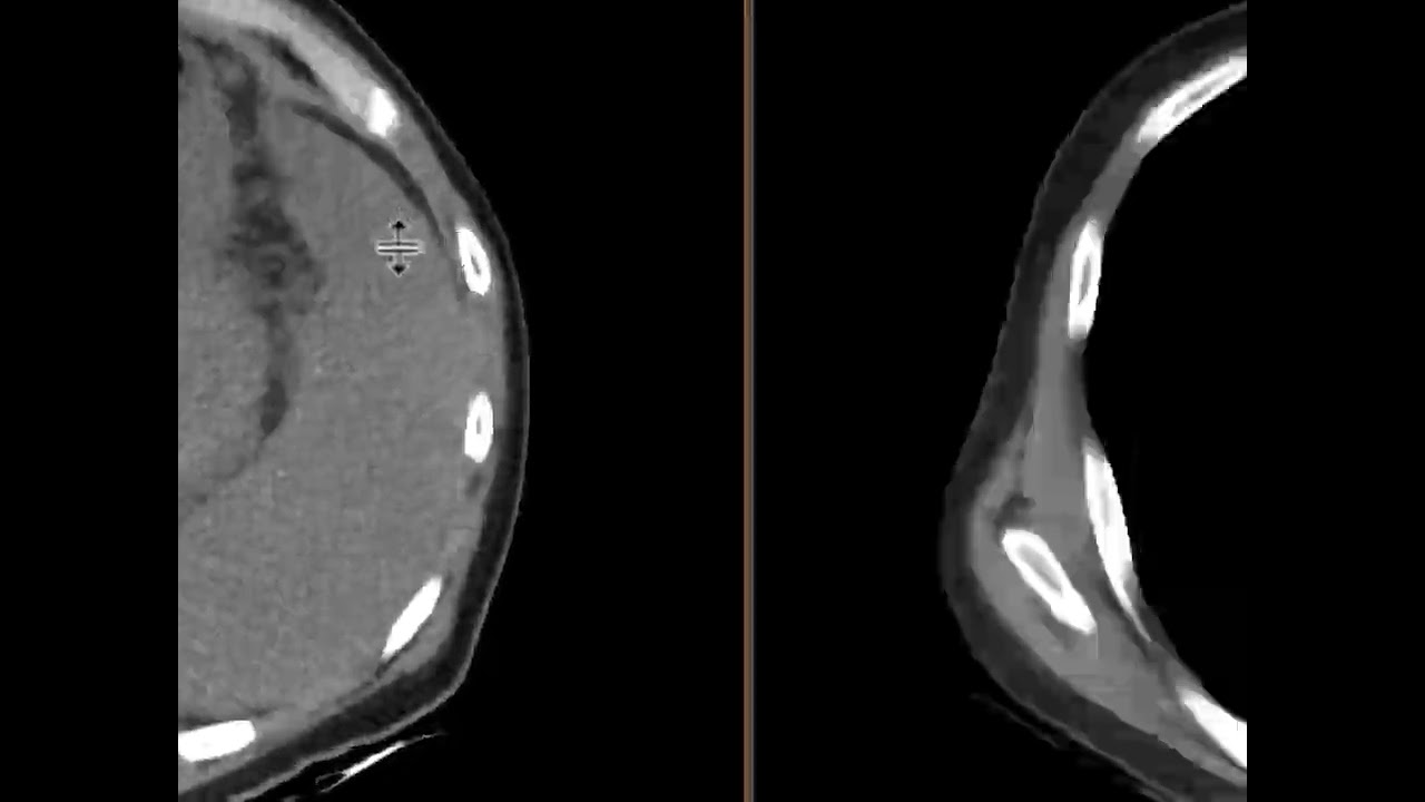 Splenic artery pseudoaneurysm