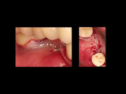 FCE13: Advances and Effectiveness in Socket Management