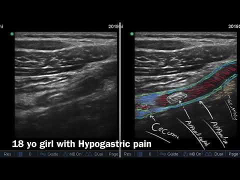 Case 223 : Long (Endless) Appendicitis