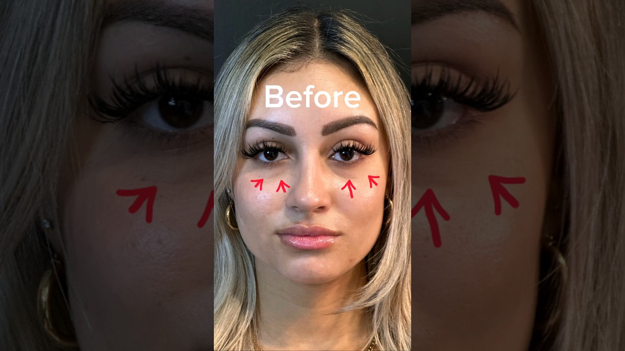 Correcting under eye bags/ dark circles with PRP filler
