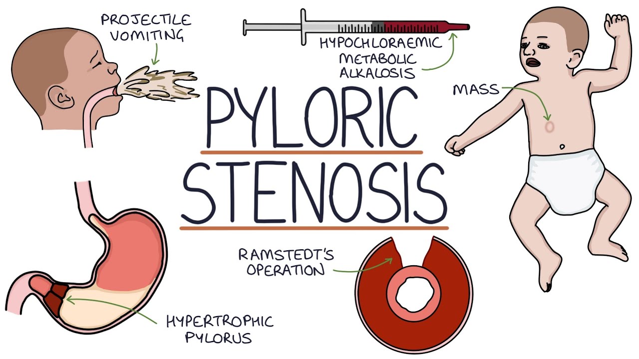 Understanding Pyloric Stenosis