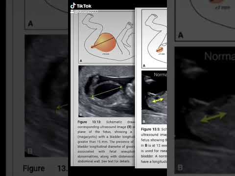 normal urinary bladder VS Abnormal Urinary bladder of fetus in usg