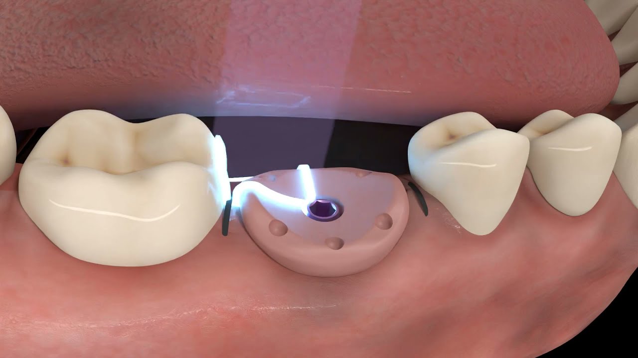 AnatotempSC Scannable Anatomic Healing Abutment