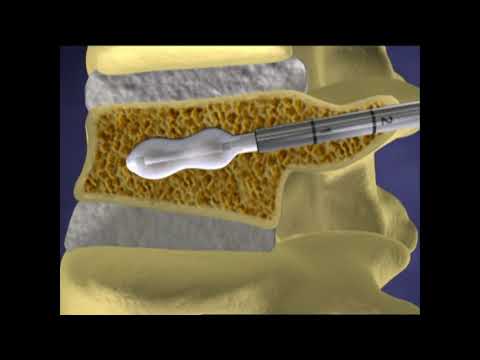 Bone Cement - Orthopedic Cement Latest Price, Manufacturers & Suppliers