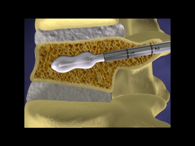 Bone Cement - Gentamicin Bone Cement Trader - Wholesaler / Distributor ...