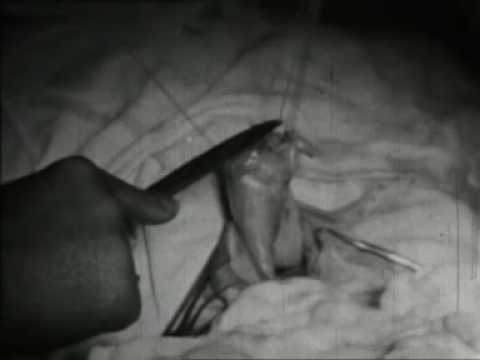 Ovariotomy for Large Cystoadenoma Ovarii (1933), pt. 2 of 4