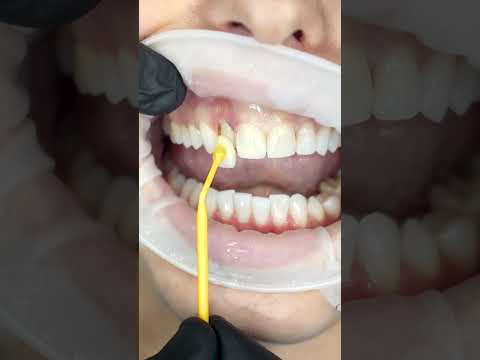 Colocar Facetas Dentárias #dentistalisboa #dentalveneers #facetas