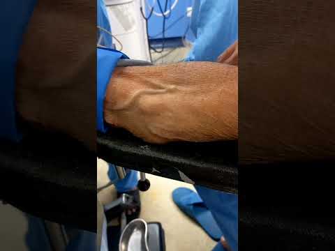 Visible pulsations of brachial artery