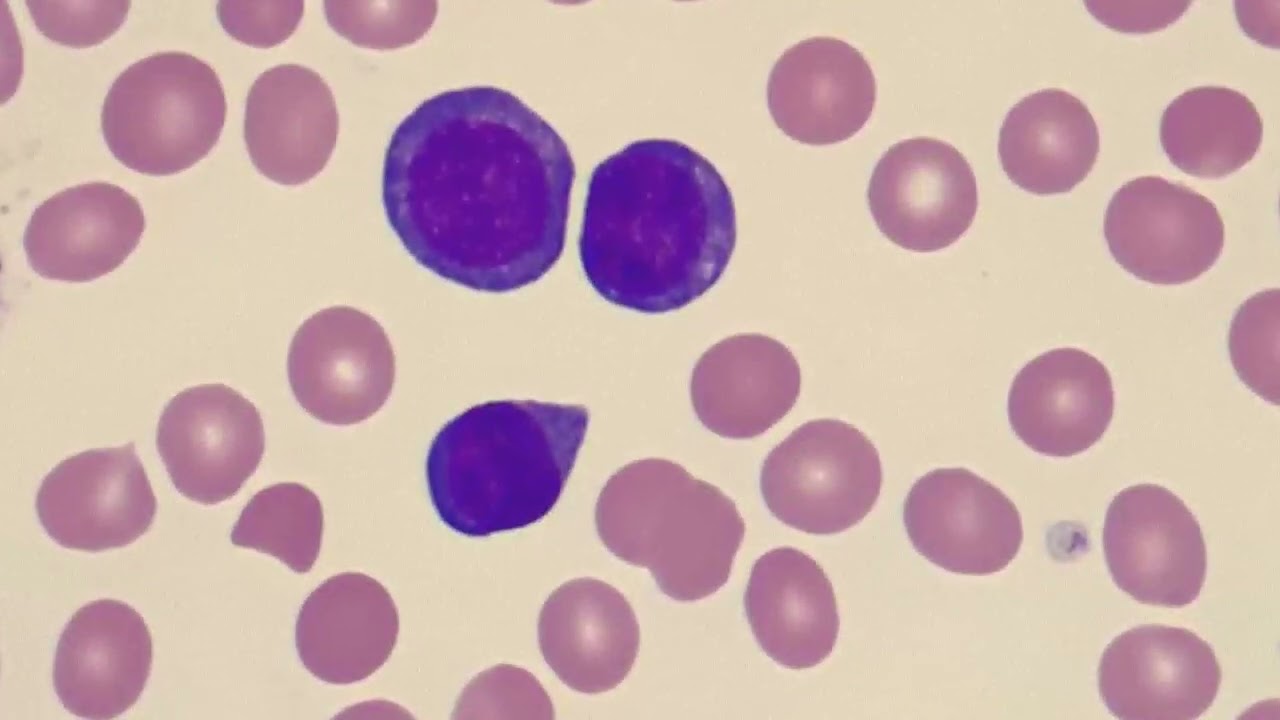 Atypical Lymphocytes