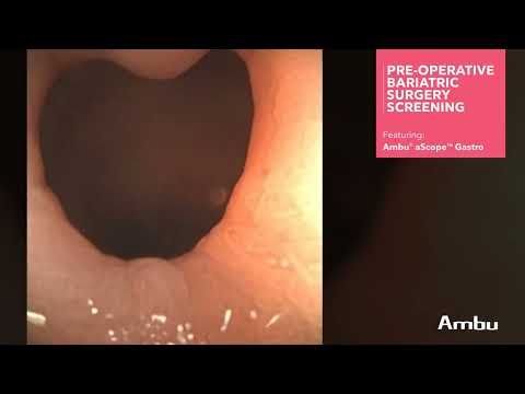 Pre-operative Screening for Gastric Bypass Using Ambu’s aScope™ Gastro