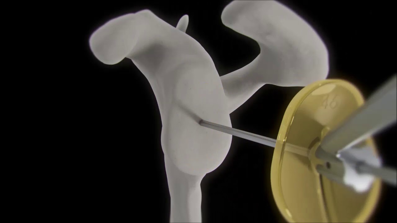 AltiVate Anatomic Surgical Technique Animation