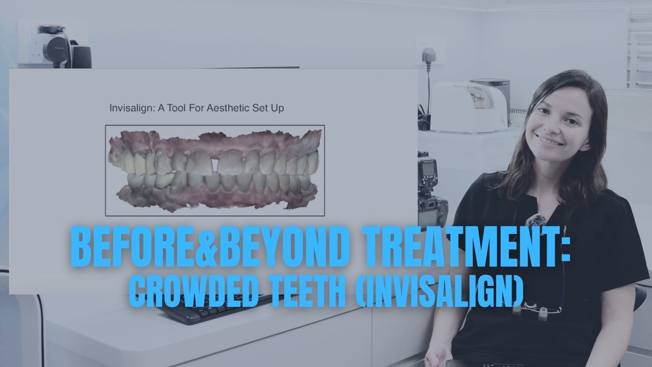Can Invisalign Fix Crowded Teeth? | BEFORE & BEYOND EP57