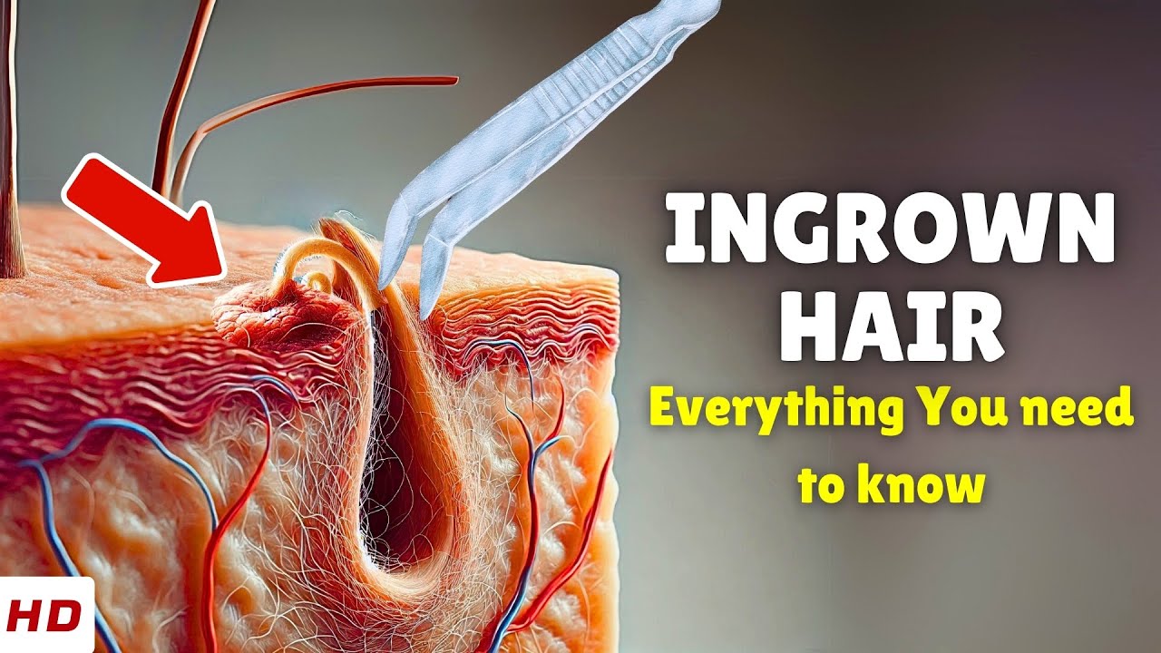 What Are Ingrown Hairs? What Causes Them, Symptoms & How to Get Rid of Them FAST!
