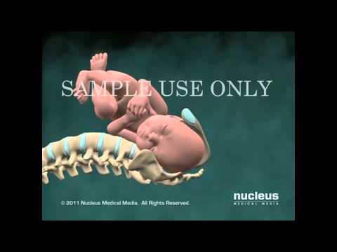 birth injury shoulder dystocia with brachial plexus stretching uterus ...