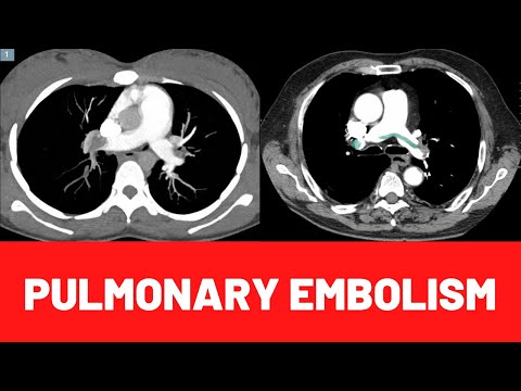 Saddle Embolism CT FINDINGS Symptoms