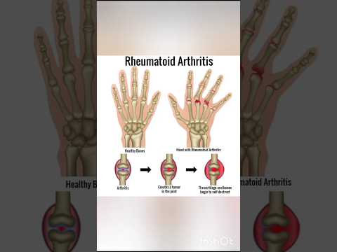 Stiff Joints in the Morning? Watch This! | Signs of Rheumatoid Arthritis (RA) #viralvideo #arthritis