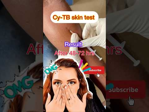 Cy-TB skin test | Tuberculosis | is this positive? #shortsfeed #youtubeshortsfeed