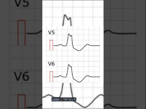 LBBB vs RBBB in 60 seconds!