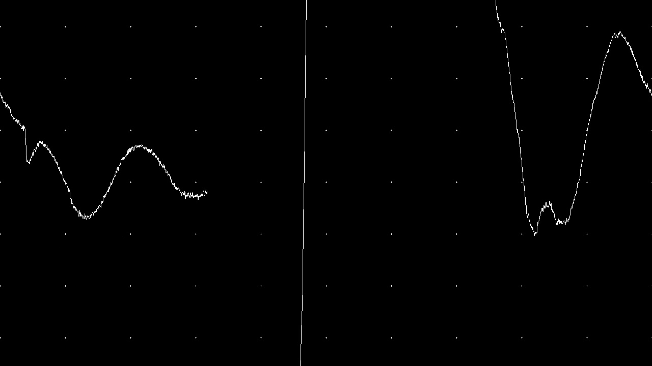 EMG teaching video 1. Normal Insertional Activity