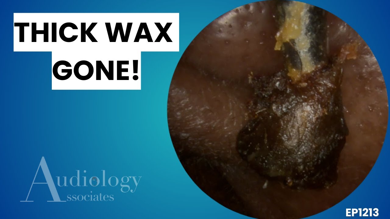 Audiologist Removes Solid Wax Plug & Sticky Skin Plate - EP1213
