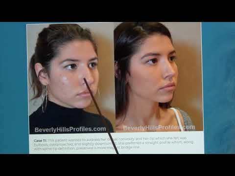 Rhinoplasty Patient Wanting Straighter Profile | Beverly Hills Profiles