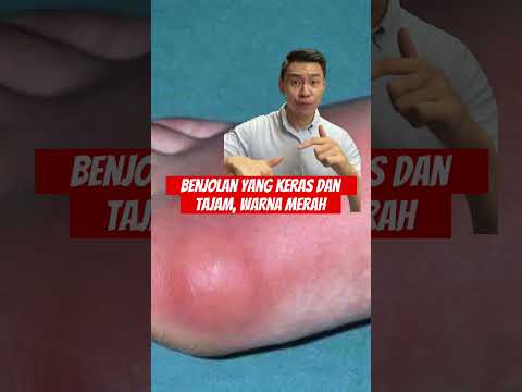 3 gejala penyakit asam urat! Kalau kamu pernah alami yang mana? #youtubehealth #dokter #asamurat
