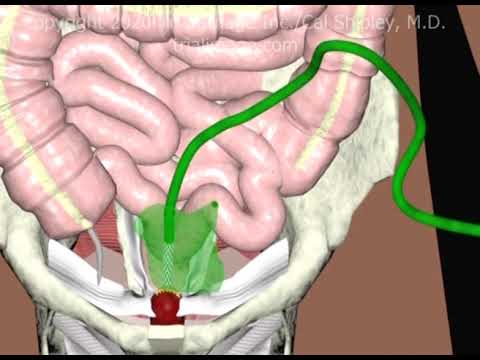 Jackson-Pratt Drain in Pelvic Surgery Animation by Cal Shipley, M.D.