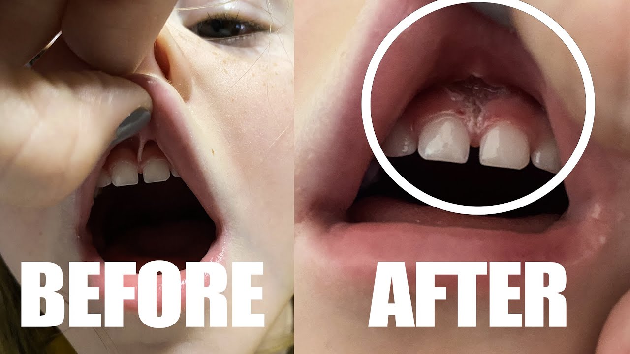 THREE YEAR OLD GETS SURGERY!  LIP TIE LASERED AT THE DENTIST