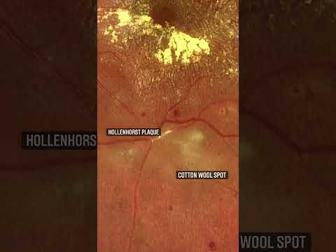 Diabetic macular edema #retina #oftalmo #ophthalmology #oftalmologia #oftalmología #ophtalmologie #