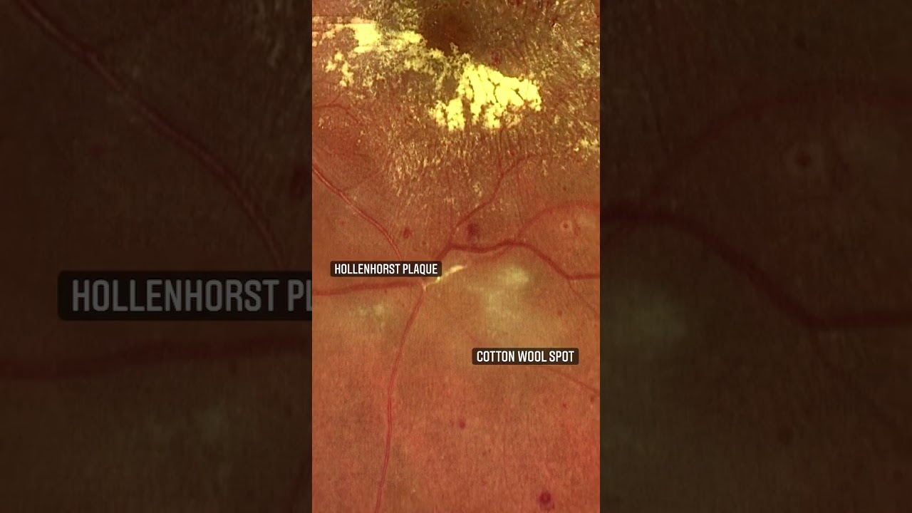 Diabetic macular edema #retina #oftalmo #ophthalmology #oftalmologia #oftalmología #ophtalmologie #