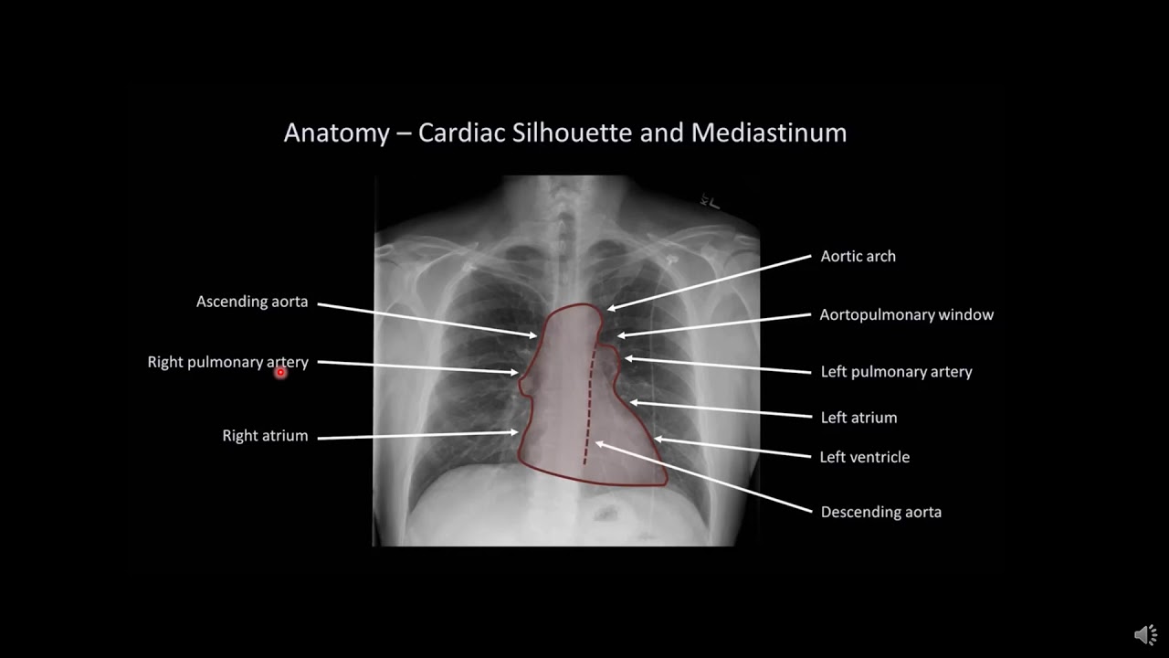Radiology - Chest X ray basic - AUDIO PPT