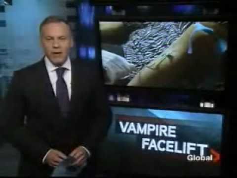 Selphyl aka "The Vampire Facelift"