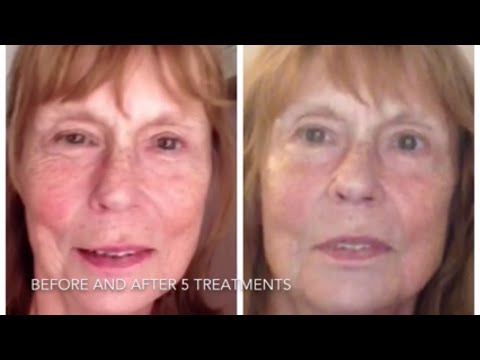 The Skin Games Week 3- After Five Microcurrent Treatments (Esthetician Olympics!)