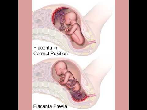 Podcast 740: Placenta Previa