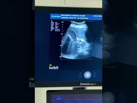 Cholelithiasis | Multiple Gallstones & Sludge in Gallbladder | Ultrasound Findings & Management