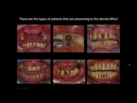 Webinar: Dr. Ara Nazarian - Atraumatic Extractions & Grafting Jan 30, 2018