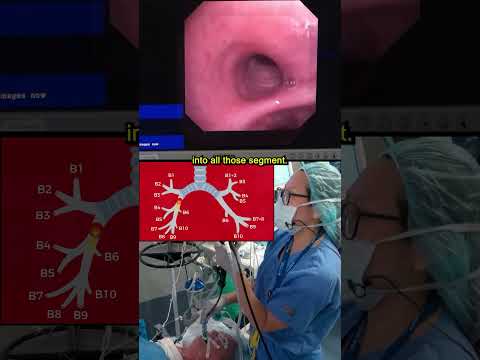 Airway Inspection : Flexible Bronchoscopy and Bronchoalveolar Lavage (BAL) #hospital #airway #surg