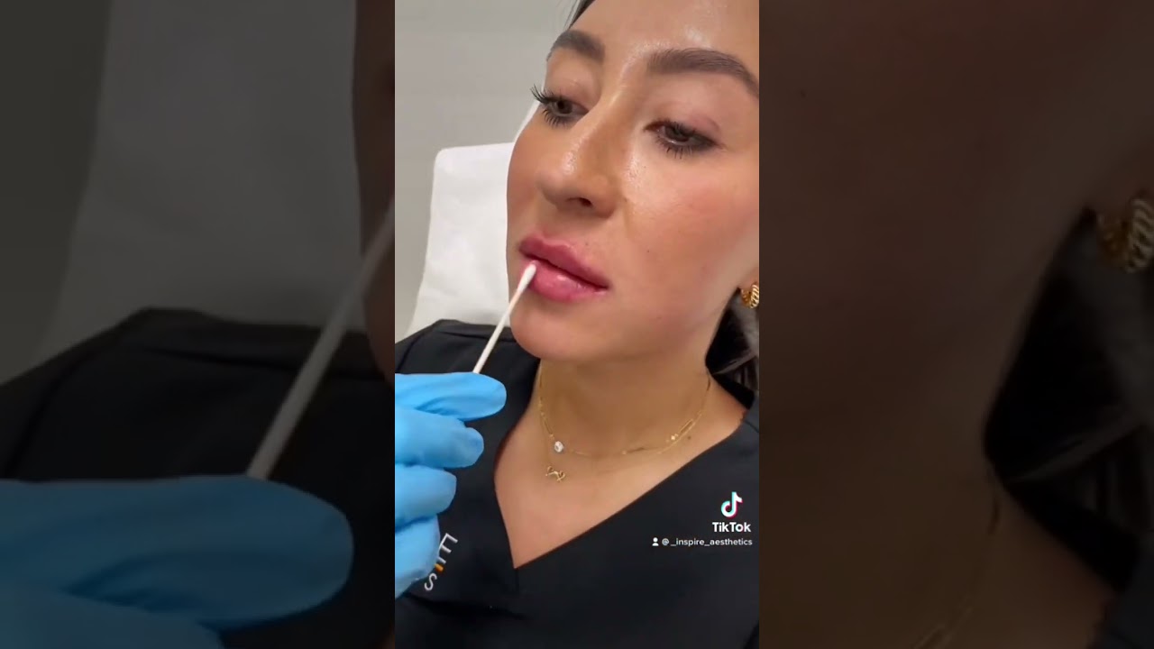 Lip filler reaction💋
