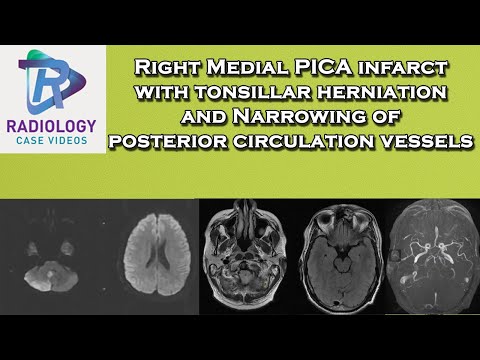 Right Medial PICA infarct with tonsillar herniation and Narrowing of posterior circulation vessels
