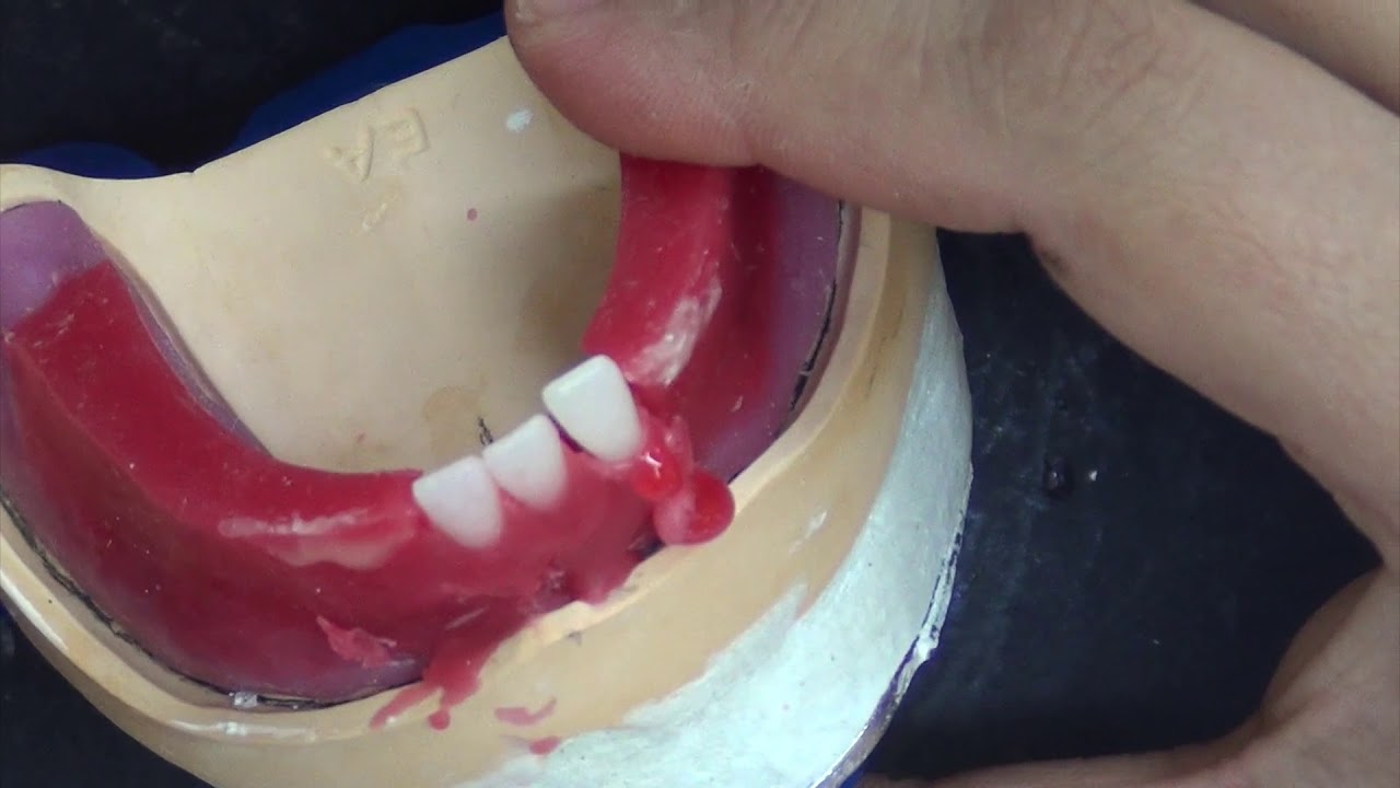 Mandibular Anterior teeth setting