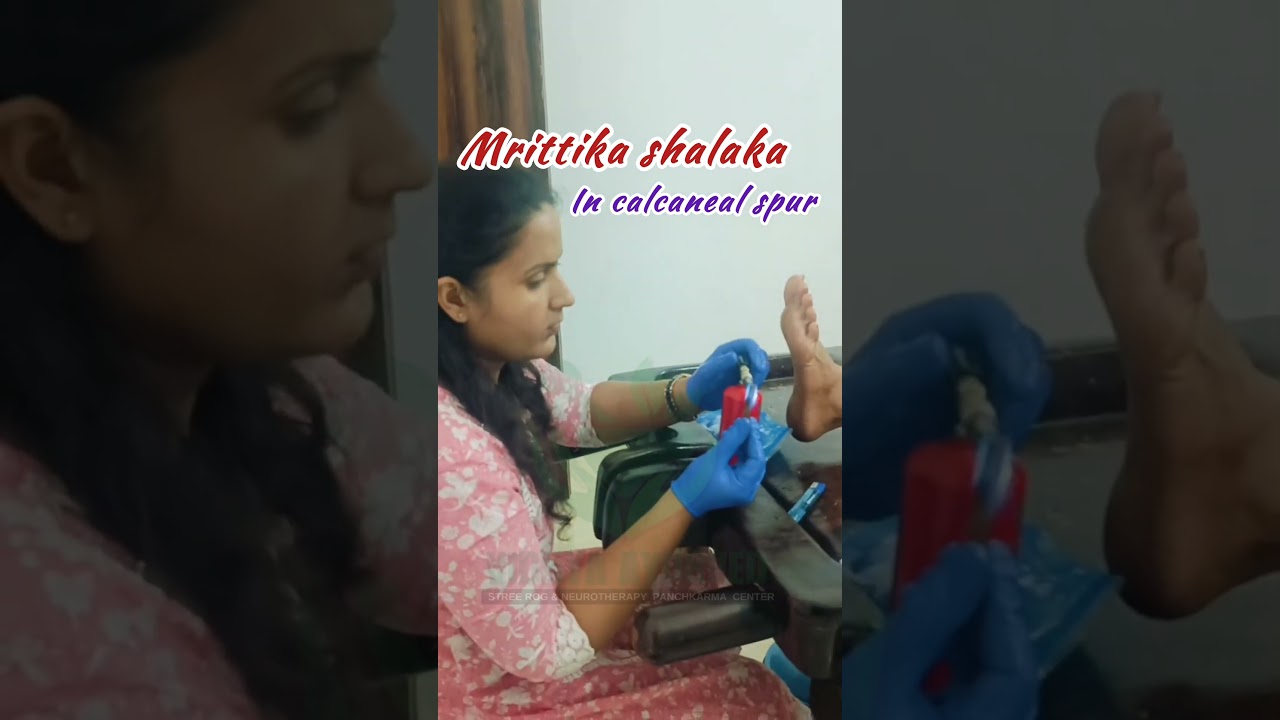 mruttika shalaka agnikarm in calcaneal spur ( heel pain)🔥#ayurveda #एडीदर्द#agnikarma#heelpain