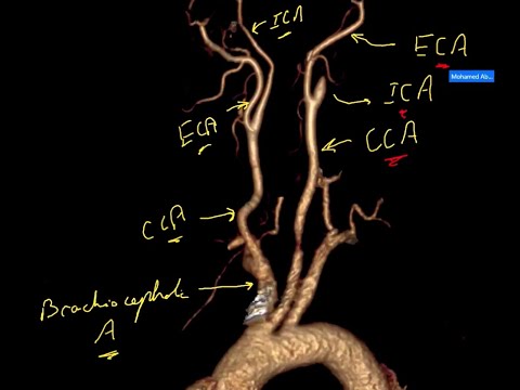 Cases #24 (Emergency CT brain course)