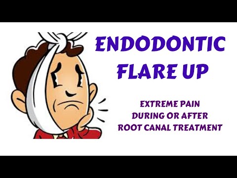 Endodontic Flare Up & Management - Extreme pain & swelling during & after root canal treatment(RCT)