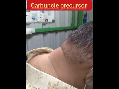 CARBUNCLE PRECURSOR FOR DIABETES | CLOSE watch on the nape of neck| Tamil | Dr BHS