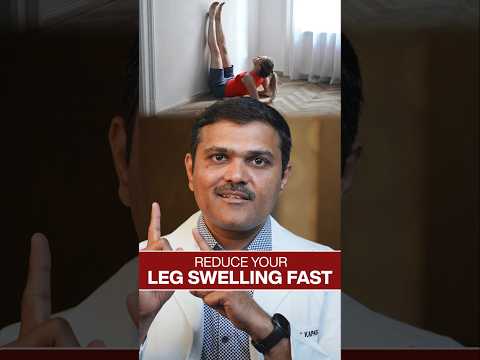 FAST Relief for Swollen Legs in 2024!